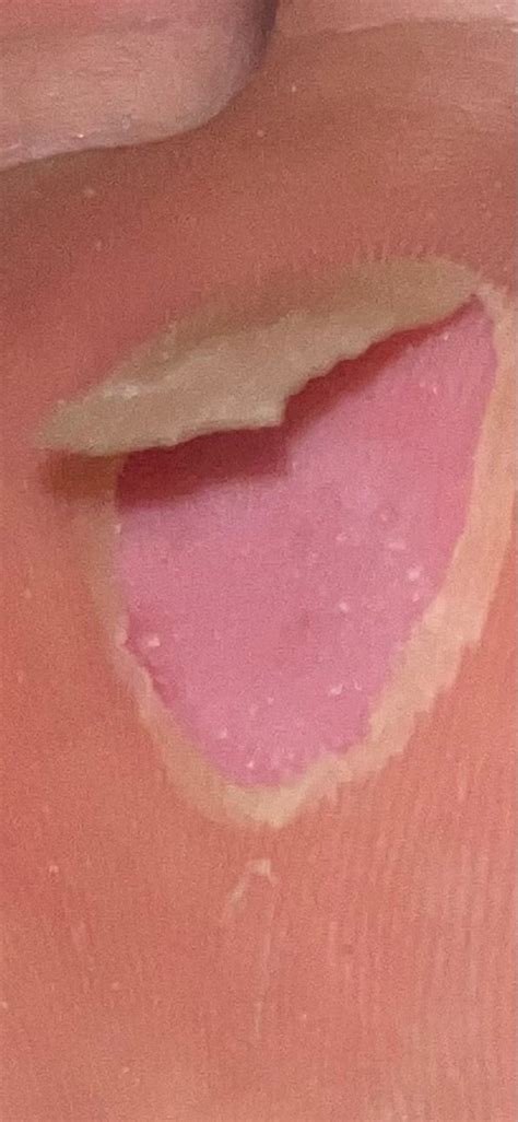 혐오주의 발바닥 하얀 물집 지식in