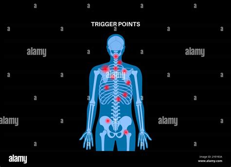 Conceptual Illustration Of Myofascial Trigger Points A Myofascial