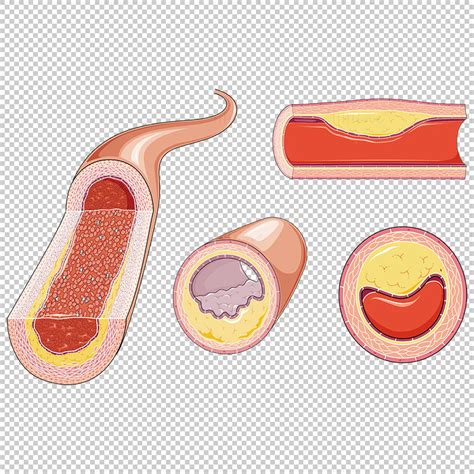 Atheroma Vector Scientific Illustration