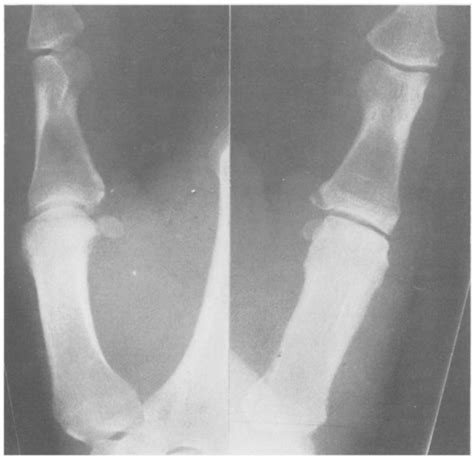 Table 1 From Experience With Arthrography Of The First Metacarpophalangeal Joint Semantic Scholar