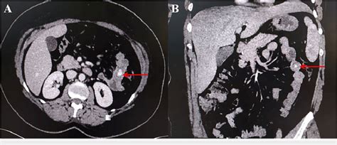 Contrast Enhanced Computed Tomography Shows Intraluminal Extravasation Download Scientific