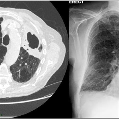 Nodular Bronchiectatic Phenotypes Of Ntm The Ct Images Left To Right