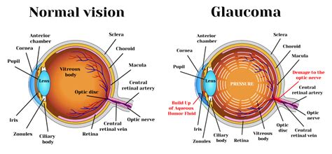 Glaucoma