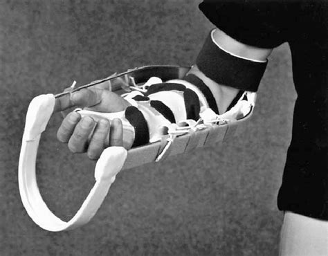 Static Progressive Splint For Supination Download Scientific Diagram