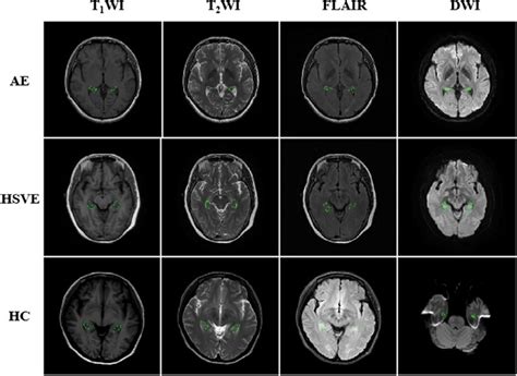 Hippocampus Annotations Rois On Multi Sequence Mri The Bilateral Download Scientific Diagram