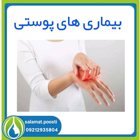 سلامت پوست درمان بیماری های پوستی درمان پسوریازیس پسوریازیس