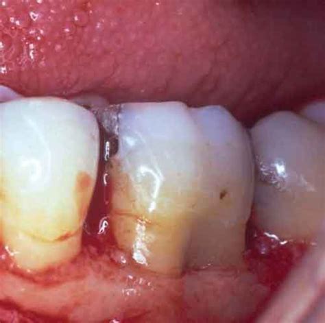 Strategies To Address Periodontally Involved Furcations Dimensions Of
