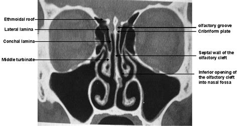 Ct Assessment Of Woodworkers Nasal Adenocarcinomas Confirms The Origin