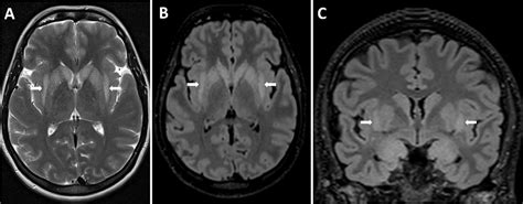 The Claustrum Sign In Febrile Infection Related Epilepsy Syndrome