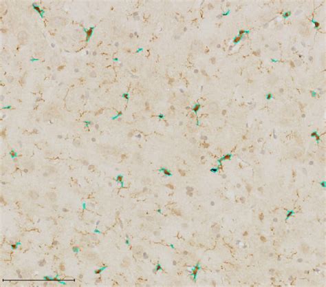 qupath number of detections per tile usage and issues image sc forum