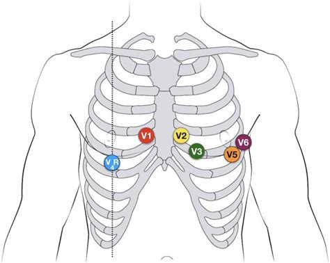 Inferior Stemi • Litfl • Ecg Library Diagnosis