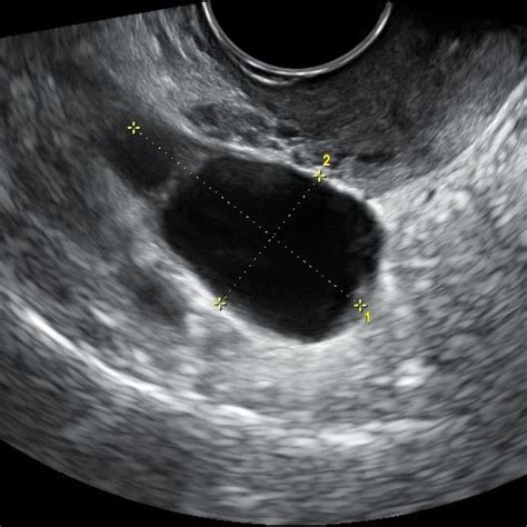 Mmotu Ovarian Ultrasound Images Dataset Kaggle