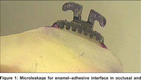 Figure 1 From Evaluation Of Microleakage Under Orthodontic Brackets Bonded With Nanocomposites