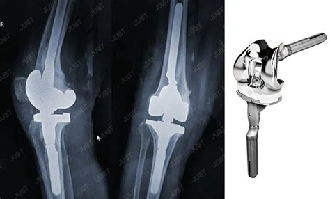 Tka Four Major Clinical Problem Solutions Extension Stem