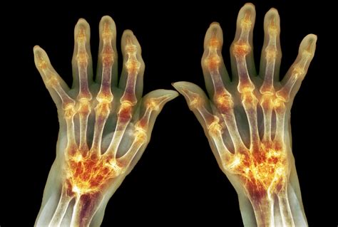 Biology Prefixes And Suffixes Arthr Or Arthro
