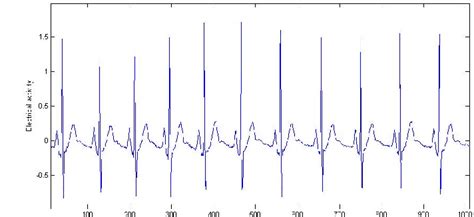 Figure 1 From Fpga Based Implementation Of A Multiplier Less Fir Filter For Ecg Signal