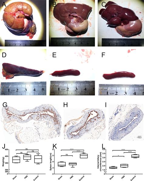 The Fms Reconstruction Relieves The Incidence Of Benign Biliary