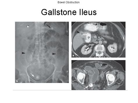 Bowel Obstruction Chapter 48 Ileus And Bowel Obstruction