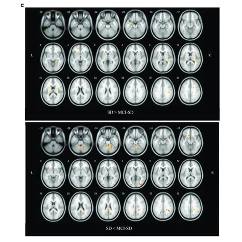 A Regions Showing Significant Differences In Default Mode Network