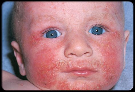 Baby Acne Cure And Treatment Baby Eczema Causes Symptom Treatment