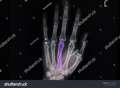 Spiral Fracture Images Stock Photos D Objects Vectors Shutterstock