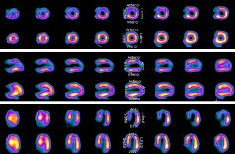 Screening Asymptomatic Patients Post Pci With Myocardial Perfusion Imaging Journal Of Nuclear