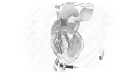 Fda Approves Wise System A Pacing Device For Crt