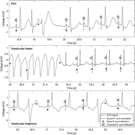 Example Of P Waves Detection In Ecgs With Various Pathologies Top