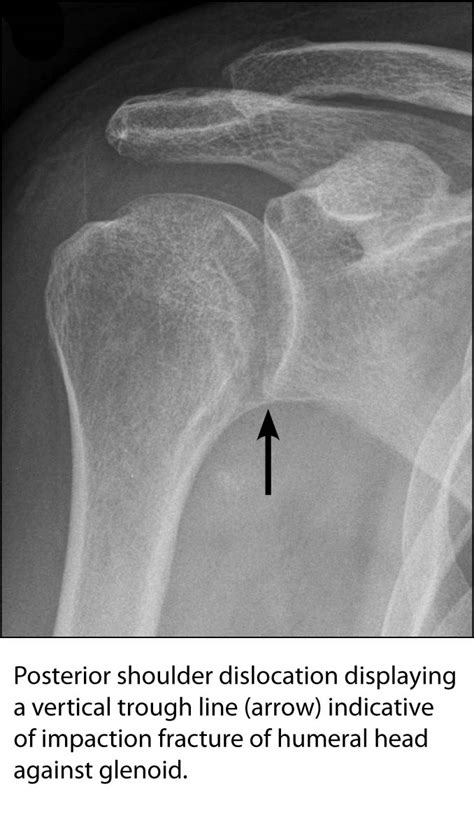 History Of Shoulder Dislocation Icd 10 At Elizabeth Simson Blog