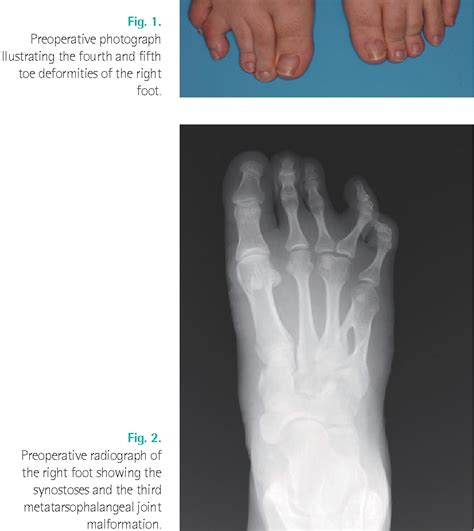 Figure 2 From Congenital Multiple Metatarsal Synostoses With Proximal Phalangeal Deformities Of
