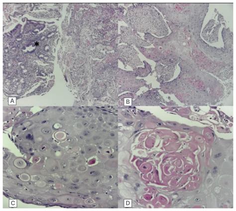 Primary Squamous Cell Carcinoma Of The Gallbladder With Hepatic Invasion A Case Report