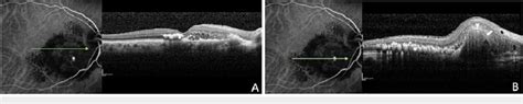 Spectral Domain Oct Scans At Baseline Obtained Through The Fovea A Download Scientific