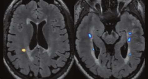 Dynamic Lesion Segmentation Of Multiple Sclerosis Plaques In This