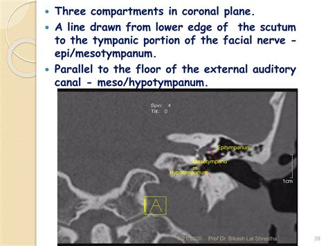 How To Read Ct Scan Temporal Bone A Dhulikhel Hospital Kathmandu