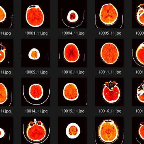 Brain Stroke Colorized Dataset Teknofest 2021 Kaggle