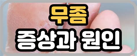 무좀 증상과 원인 치료에 좋은 무좀연고 정보