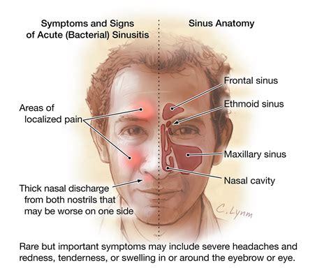 Eye Swelling Sinusitis At Aaron Levine Blog