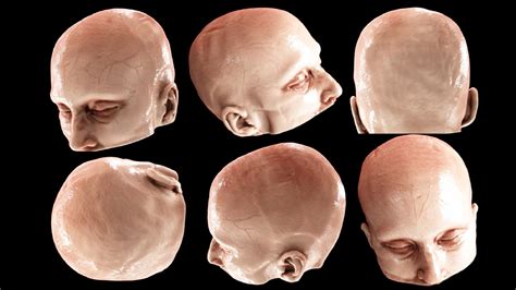 Photorealistic Depiction Of Intracranial Tumors Using Cinematic