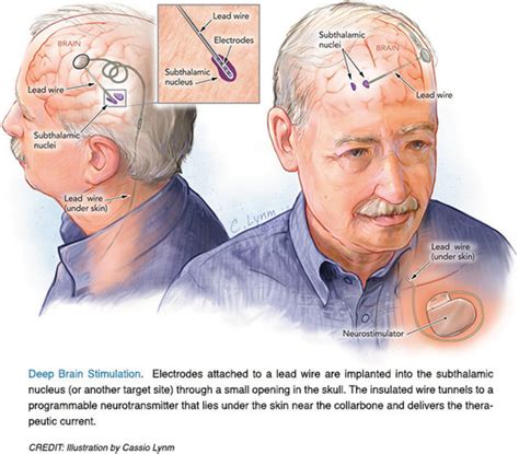 Effectiveness Of Microelectrode Recording For Determining The