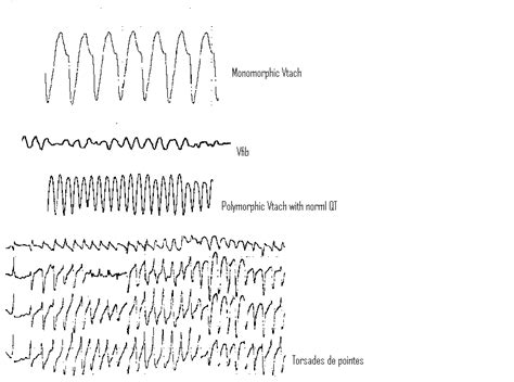 Difference Between Ventricular Tachycardia Vtach And 56 OFF