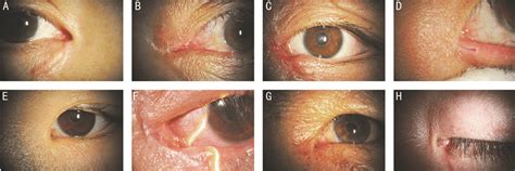 Deformities Of The Medial Canthus A Normal Control B Lacrimal