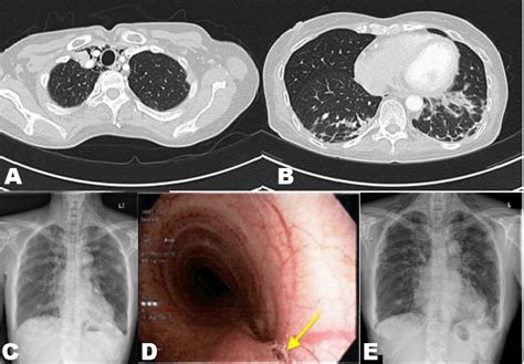 A Ct Chest Multiple Peripheral Patches Of Consolidation Are Seen In
