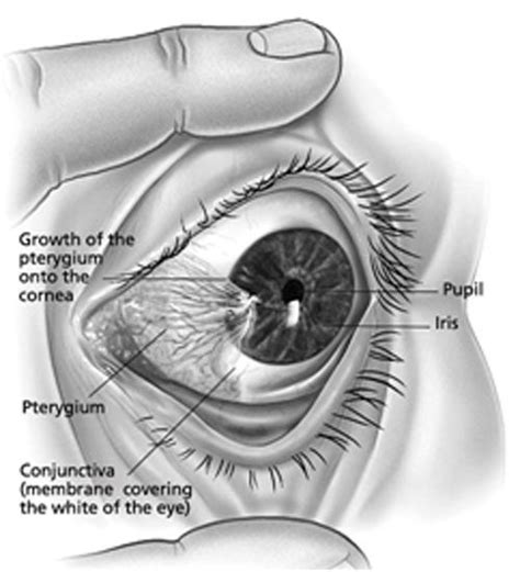Pterygium Eye Surgery