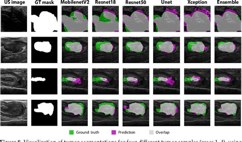 Figure 8 From Tumor Segmentation In Colorectal Ultrasound Images Using