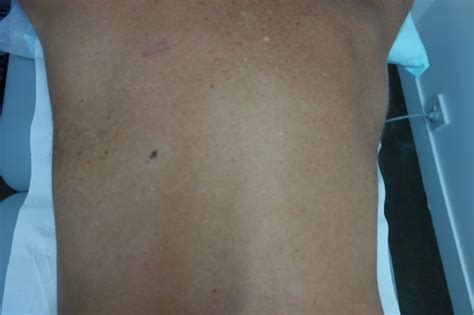 The Difficulty Of Melanoma Assessment Molescreen PDT