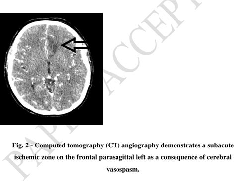 ˗ Spontaneous Subarachnoid Hemorrhage Extending Into The Basal And