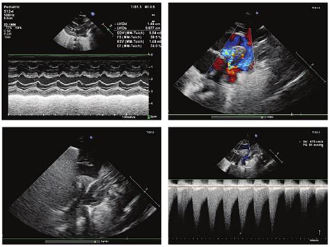 Echocardiography Showed Left Ventricular Dilatation And Hypertrophy