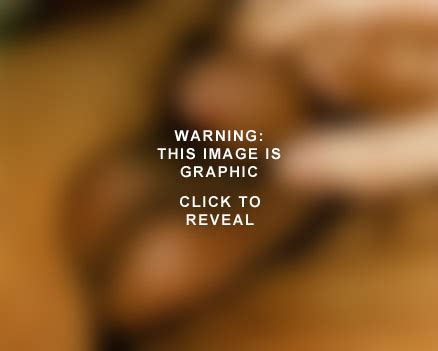 What Do The Symptoms Of Sexually Transmitted Diseases Look Like