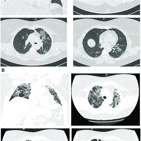 A Case 2 Multiple Patchy Nodular Or Large Opacity And Ggo Under The