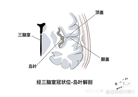 手绘 岛叶与岛叶胶质瘤